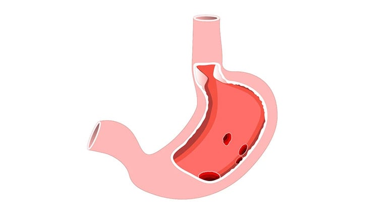 Throwing up Blood after Drinking – Page 4 – Entirely Health