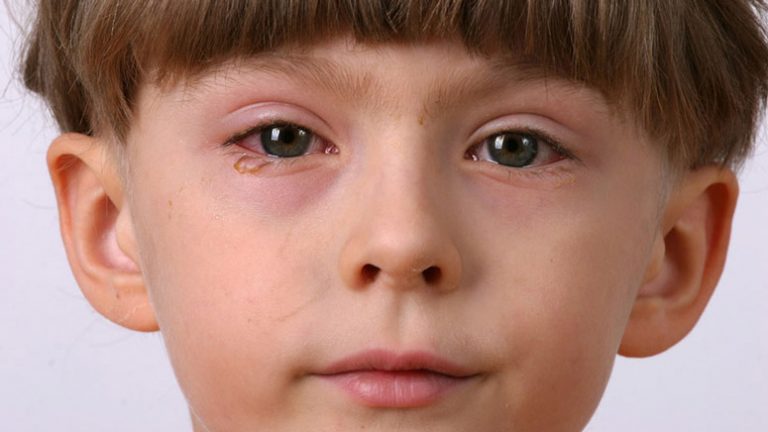 Conjunctivitis (Pink Eye) – Signs and Symptoms – Entirely Health