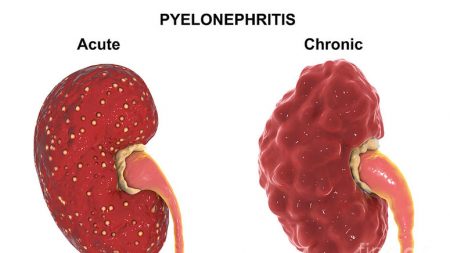 The Symptoms of Kidney Infection (Pyelonephritis) – Entirely Health