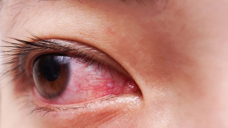Conjunctivitis (Pink Eye) – Signs and Symptoms – Entirely Health
