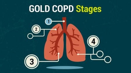 What Are The Four Stages of COPD? – Page 2 – Entirely Health