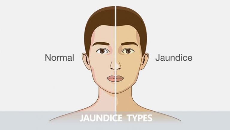What is Jaundice? – Page 4 – Entirely Health