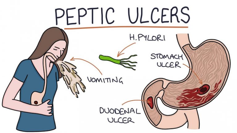 Stomach Ulcer(Peptic Ulcer): Symptoms and Causes – Page 7 – Entirely Health