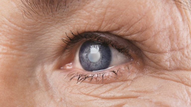 Common Symptoms of Cataracts – Page 8 – Entirely Health