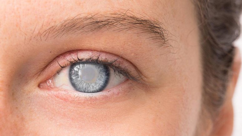 Common Symptoms of Cataracts – Page 4 – Entirely Health