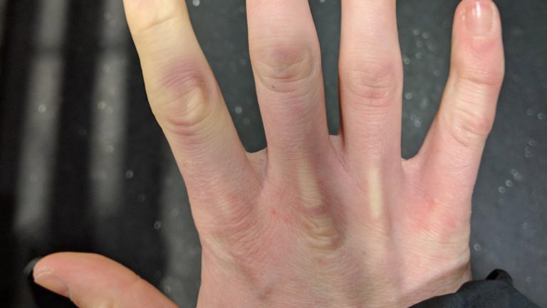 Early Symptoms of Scleroderma – Page 2 – Entirely Health