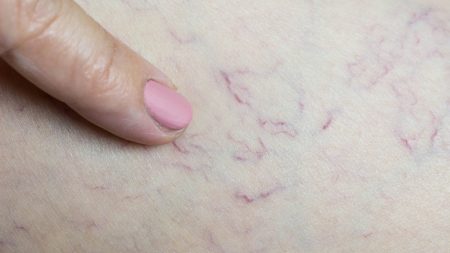 Cushing’s Syndrome Symptoms – Page 2 – Entirely Health