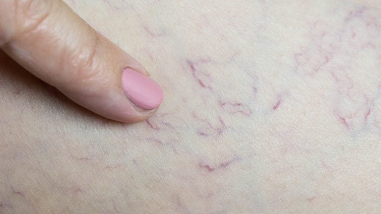 Cushing’s Syndrome Symptoms – Page 2 – Entirely Health