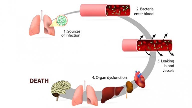 Sepsis Stages and Symptoms – Page 2 – Entirely Health