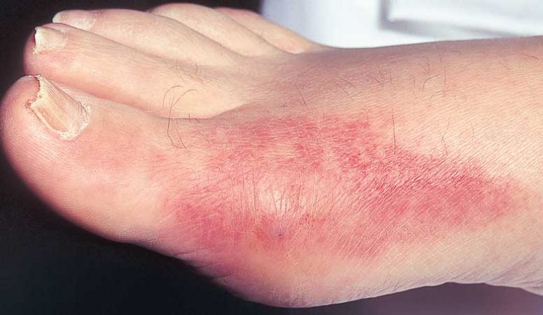 Some Facts That You Should Know Are about Gout (Gouty Arthritis) – Page ...