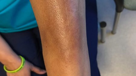 Early Symptoms of Scleroderma – Entirely Health