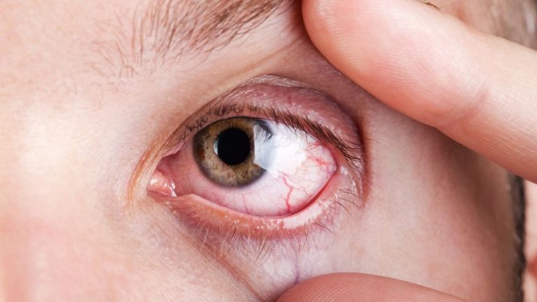 Lupus Signs & Symptoms – Page 5 – Entirely Health