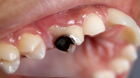 Calcium Deficiency (Hypocalcemia) Symptom – Page 5 – Entirely Health