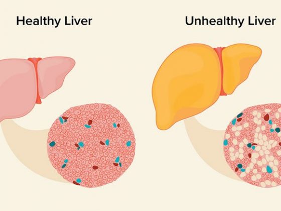 Fatty Liver (Hepatic Steatosis): Most Common Signs and Symptoms ...