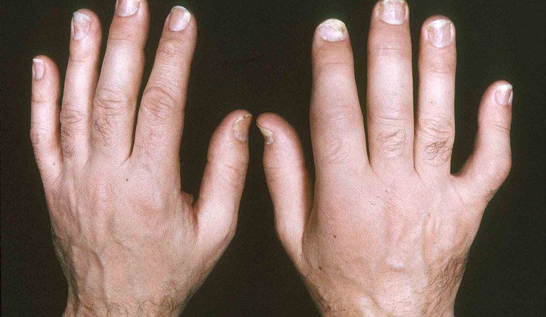 Common Facts about Psoriatic Arthritis – Page 2 – Entirely Health