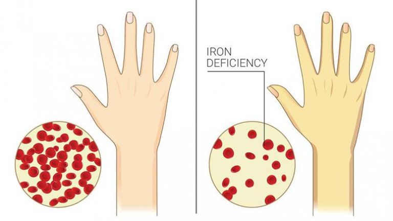 Iron Deficiency (Low Iron) Signs & Symptoms – Entirely Health