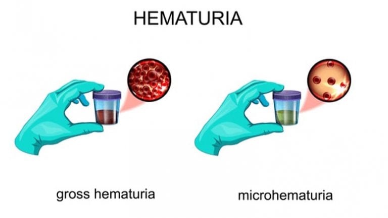 Hematuria(Blood in Urine): 10 Major Causes to Know – Entirely Health