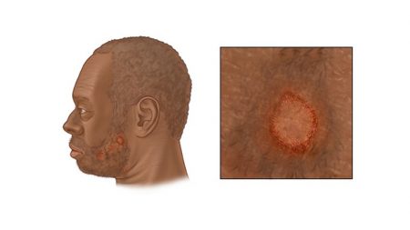 Ringworm Symptoms by Location – Page 4 – Entirely Health