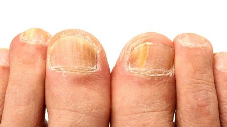 Ringworm Symptoms by Location – Page 3 – Entirely Health