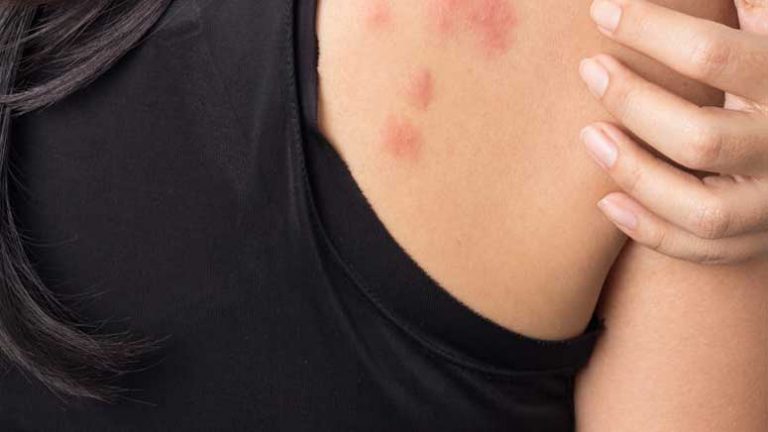 How to Identify BedBug Bites? – Page 5 – Entirely Health