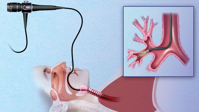 Common Treatments for Severe Asthma – Page 5 – Entirely Health