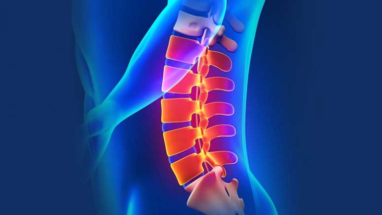 8 Treatments for Bone Spurs – Entirely Health