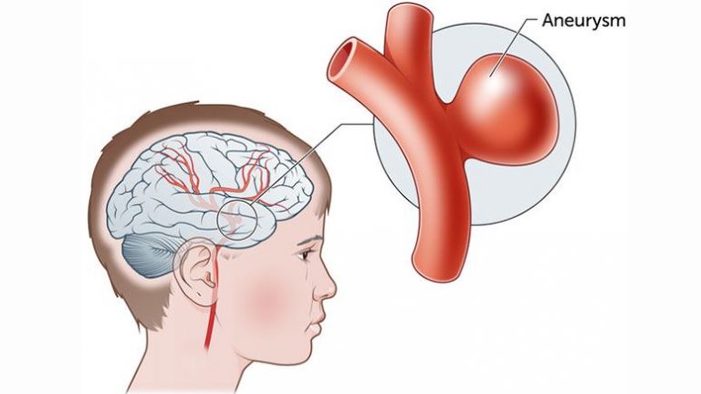 5 Causes of Brain Aneurysm – Entirely Health
