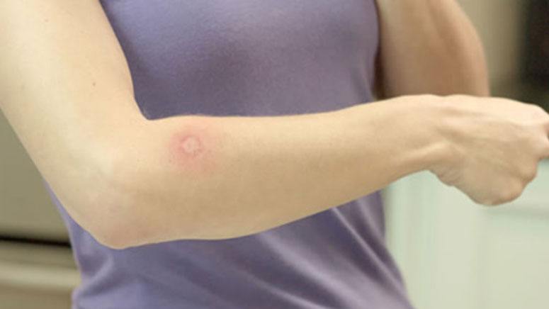 Home Remedies for Ringworm – Entirely Health