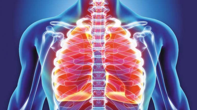 Chronic Bronchitis Fact Sheet – Entirely Health