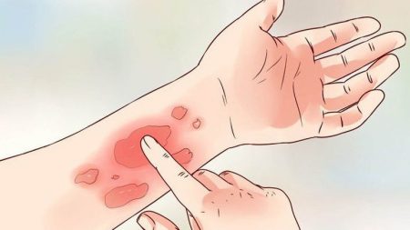4 Symptoms of Hives You Should Know – Entirely Health