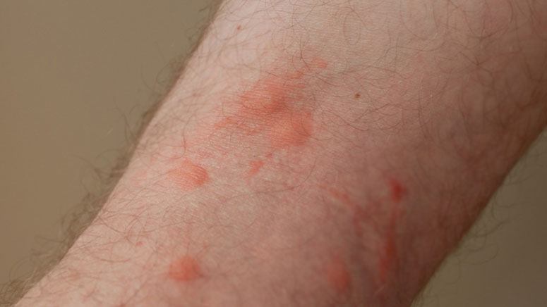How to Identify Insect (Bug) Bites? – Page 8 – Entirely Health
