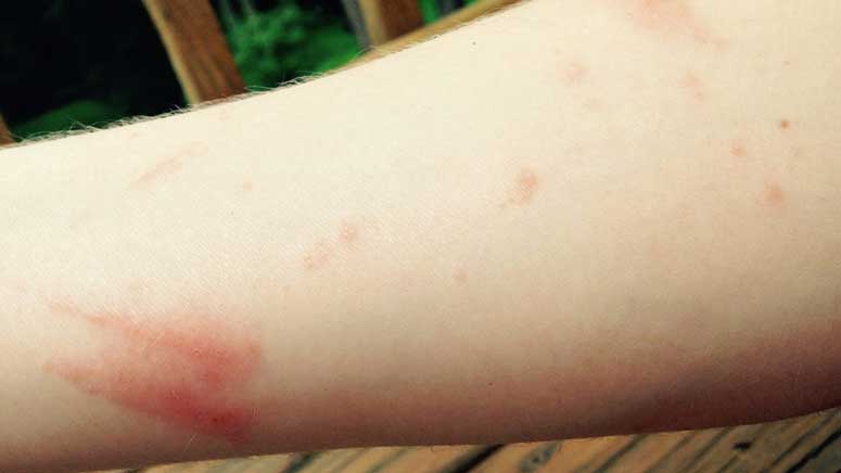 How to Identify Insect (Bug) Bites? – Page 8 – Entirely Health