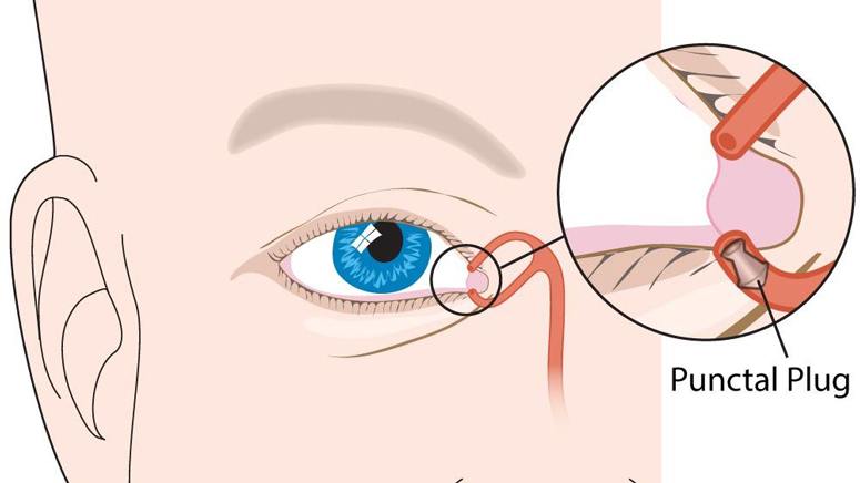 Dry Eye Treatments: What Are Your Options? – Page 5 – Entirely Health