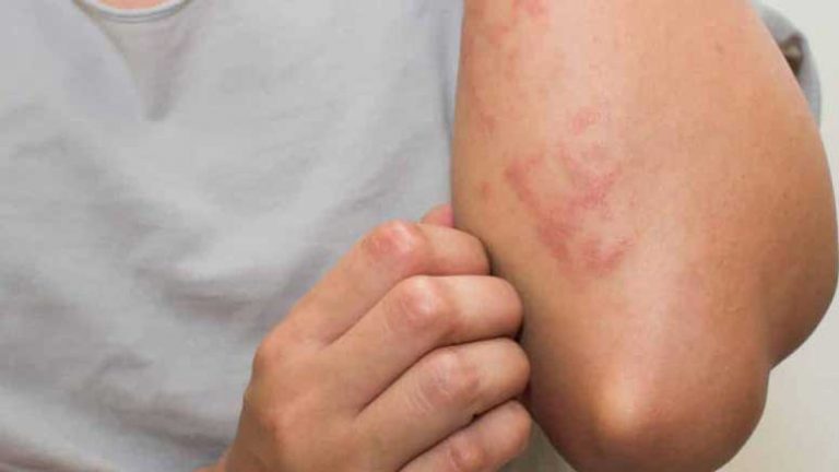 Most Common Symptoms of Plaque Psoriasis – Page 2 – Entirely Health