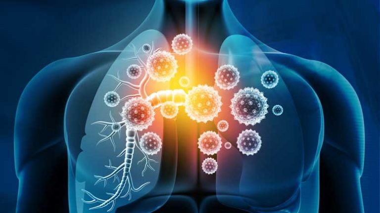 Pleurisy – Symptoms And Causes – Page 5 – Entirely Health