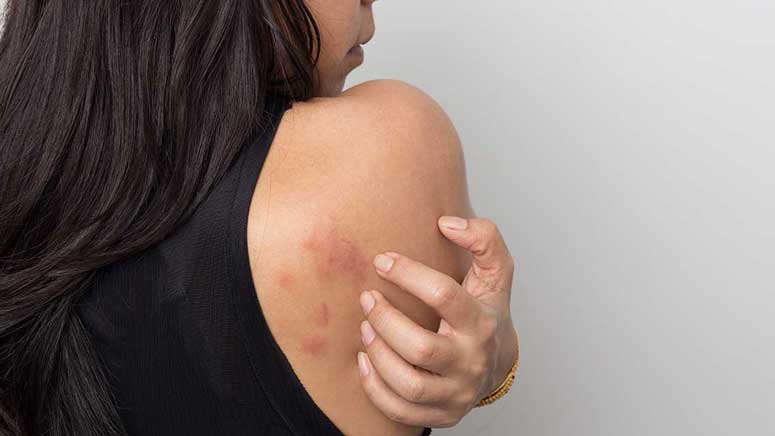 7 Major Causes of Hives – Page 3 – Entirely Health