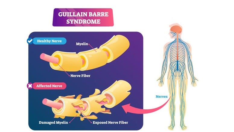 Guillain-Bare Syndrome Fact Sheet – Page 2 – Entirely Health