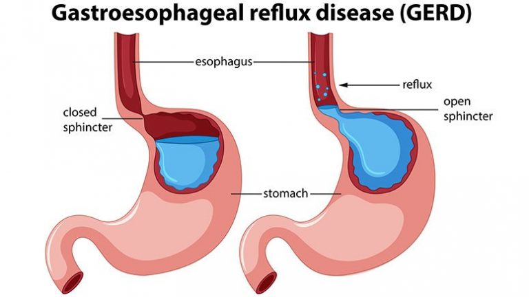 Esophageal Spasms – Symptoms and Causes – Page 2 – Entirely Health