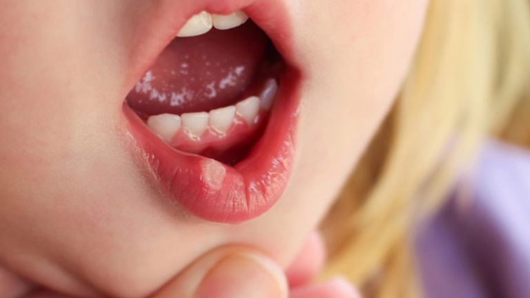 Common Causes and Risk Factors of Oral Thrush – Entirely Health