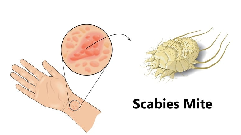 Everything You Should Know About Scabies Causes – Page 6 – Entirely Health