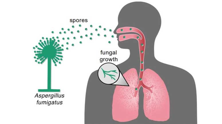 Everything You Need To Know About Aspergillosis – Page 2 – Entirely Health