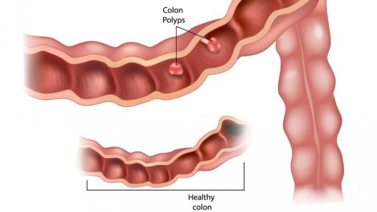 Colon Polyps – Symptoms, Causes and Risk Factors – Entirely Health