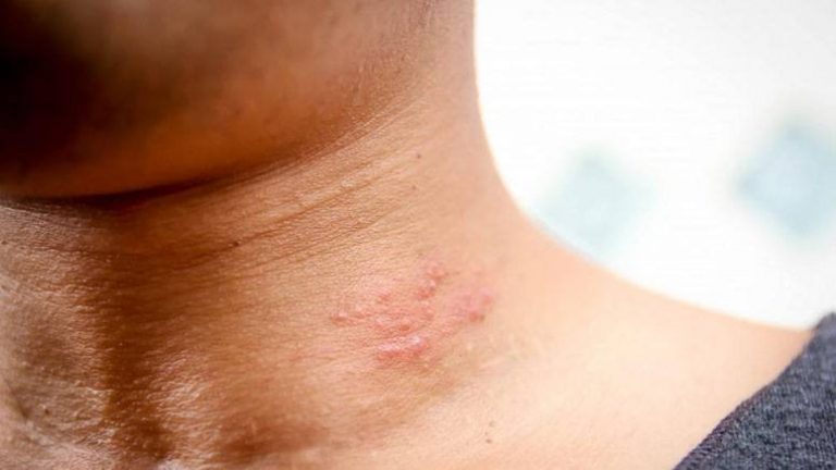 Shingles vs. Herpes: Symptoms, Causes & More – Entirely Health