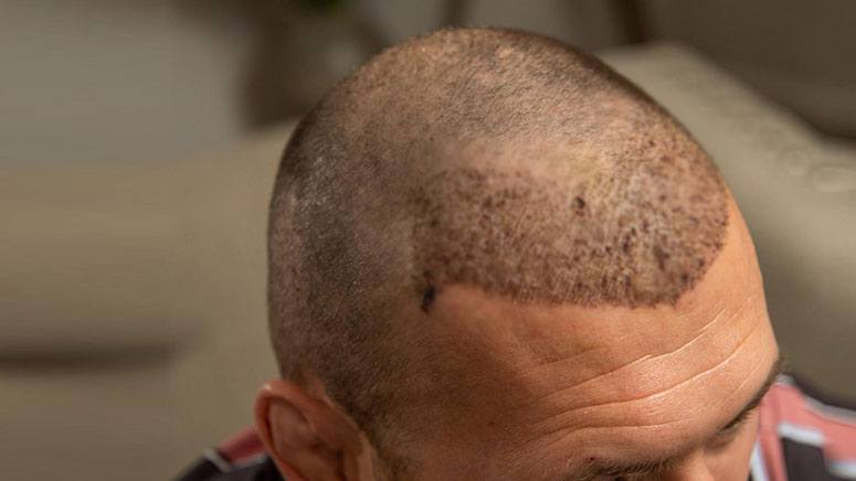 Infected Hair Transplant – Causes, Symptoms, and Treatments – Page 4 ...