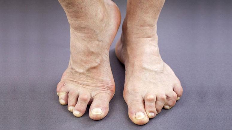 Rheumatoid Arthritis in the Feet – Symptoms, Effects & Treatments ...
