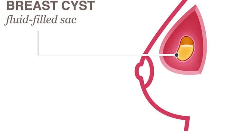Breast Lumps: Cancerous vs. Noncancerous – Page 4 – Entirely Health