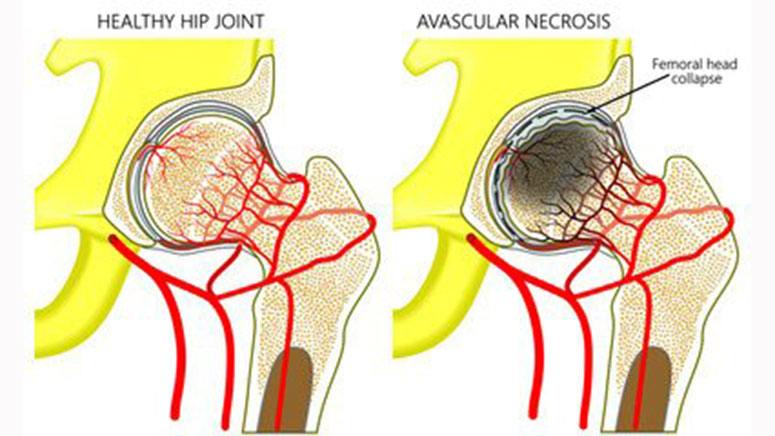 Understanding the Five Types of Shoulder Arthritis – Page 6 – Entirely ...