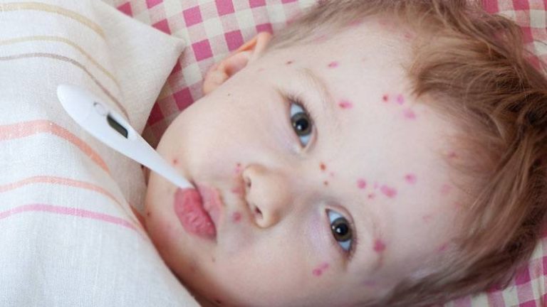 Chickenpox vs. Shingles—What’s the Difference? – Page 4 – Entirely Health