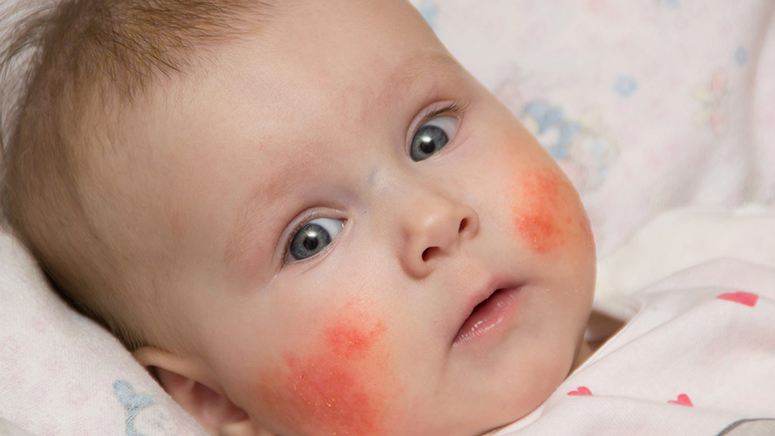 Facial Eczema: Types, Treatment, and Prevention – Page 5 – Entirely Health