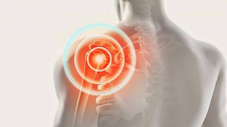 Understanding the Five Types of Shoulder Arthritis – Page 4 – Entirely ...